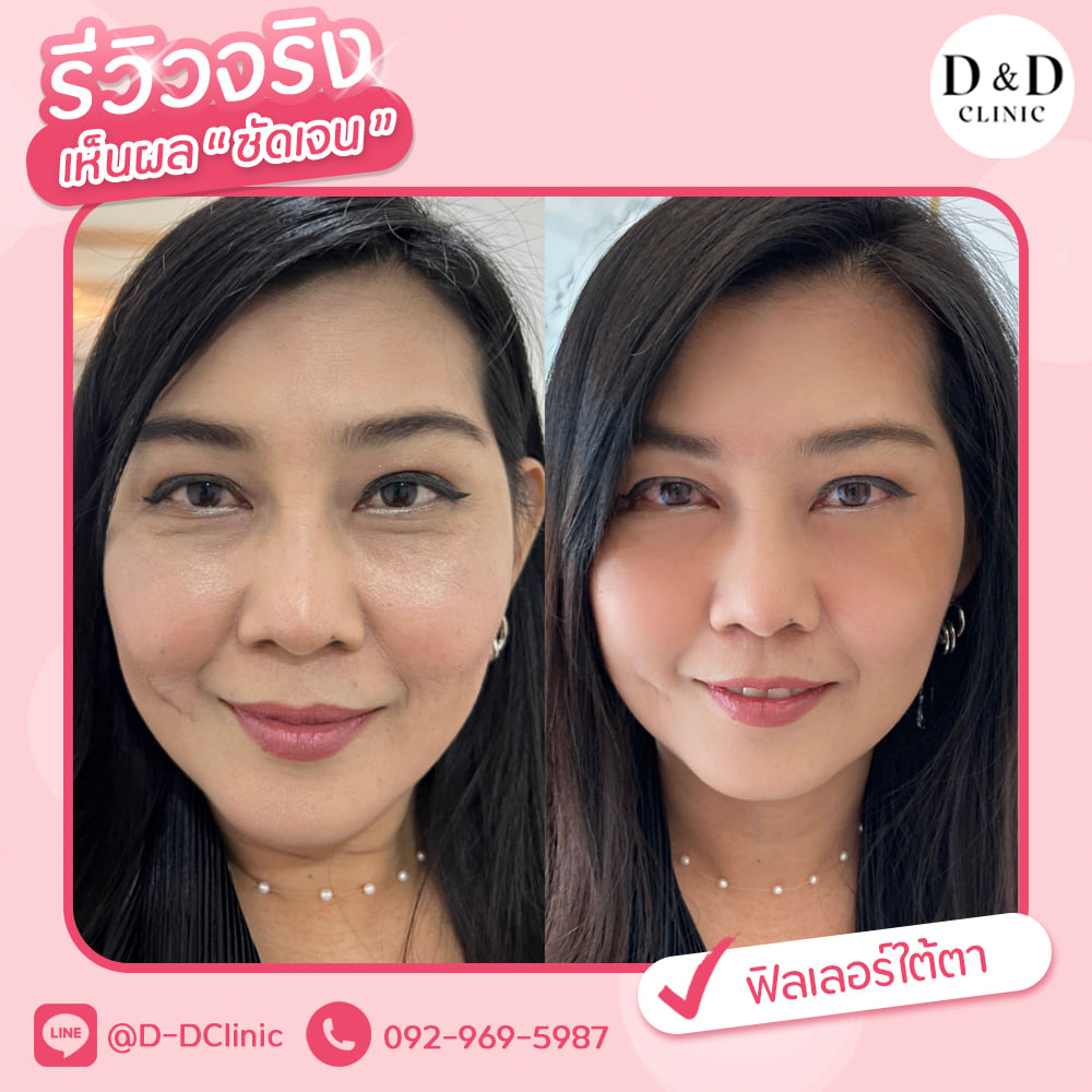 รีวิว Filler E.p.t.q - D&D Clinic