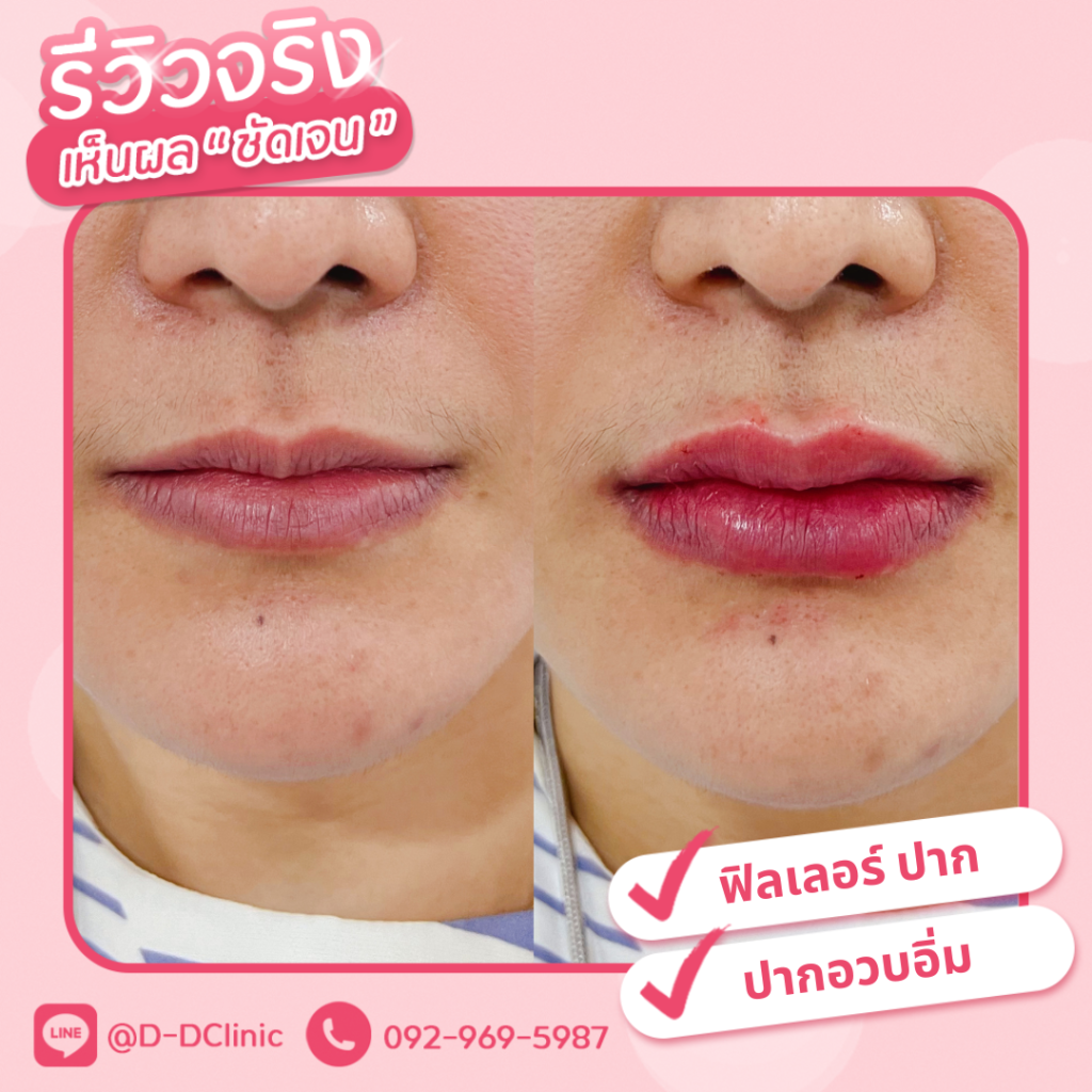 รีวิว Filler E.p.t.q - D&D Clinic
